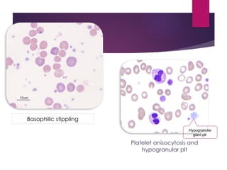 Diagnosis of Myelodysplastic Syndrome.ppt