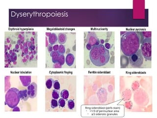 Diagnosis of Myelodysplastic Syndrome.ppt