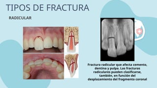9. Tipos de fractura dentales y avulsiones.pptx