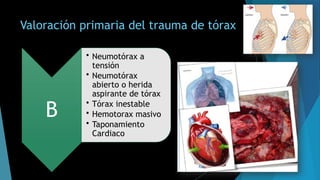 9.- TRAUMA DE TORAX - Cir. Cara y cuello | PPTX