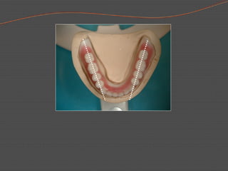Setting posterior teeth .complete denture | PPT