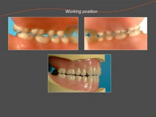 Setting posterior teeth .complete denture | PPTX