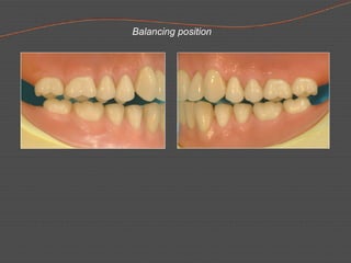 Setting posterior teeth .complete denture | PPTX