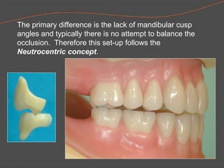 Setting posterior teeth .complete denture | PPT
