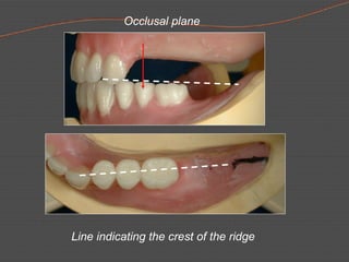 Setting posterior teeth .complete denture | PPTX