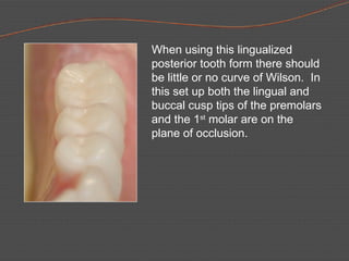 Setting posterior teeth .complete denture | PPTX