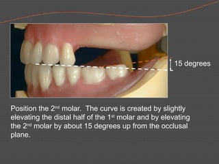Setting posterior teeth .complete denture | PPTX