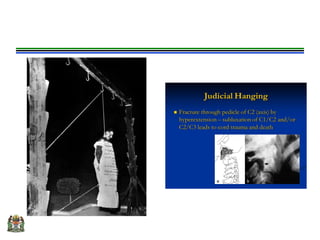 9.0 INJURIES AND DEATHS DUE TO HANGING.pptx