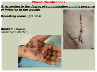 Wounds. wound process. Their classification, treatment, drugs. | PDF