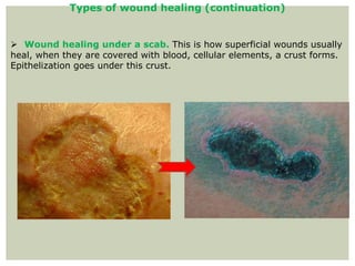 Wounds. wound process. Their classification, treatment, drugs. | PDF