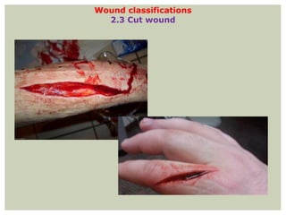 Wounds. wound process. Their classification, treatment, drugs. | PPT