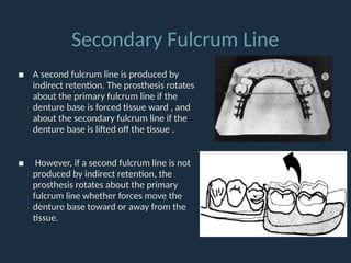 9. Indirect Retainers in removable partial denture | PPTX