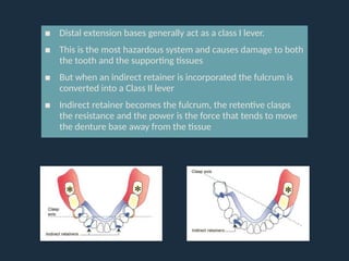 9. Indirect Retainers in removable partial denture | PPTX