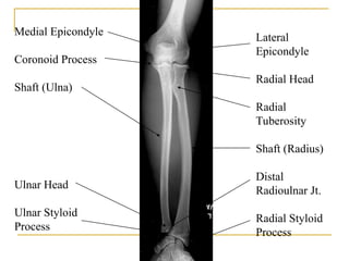 upper limb anatomy and radiological master in upper limb | PPT