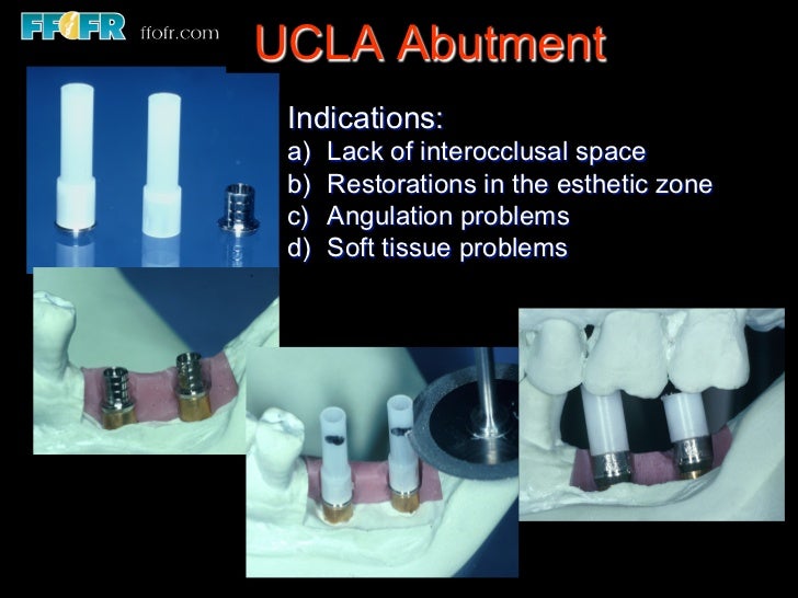 Abutment Selection