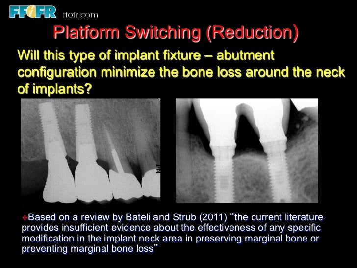 Abutment Selection