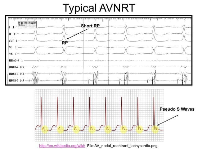 9.avnrt chang sl-0324-2 | PDF | Heart and Cardiovascular Diseases ...