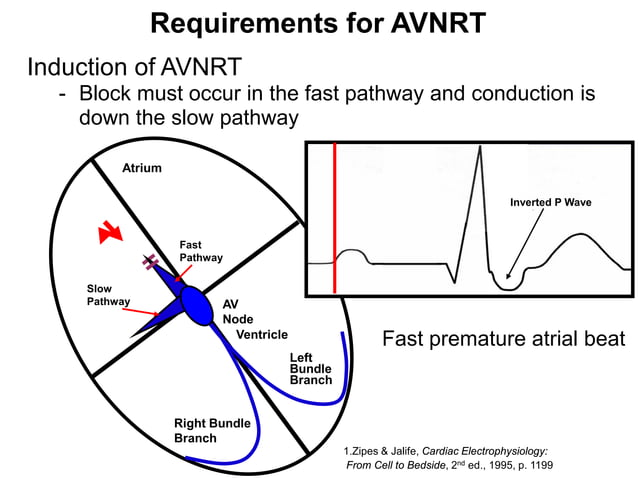 9.avnrt chang sl-0324-2 | PDF | Heart and Cardiovascular Diseases ...