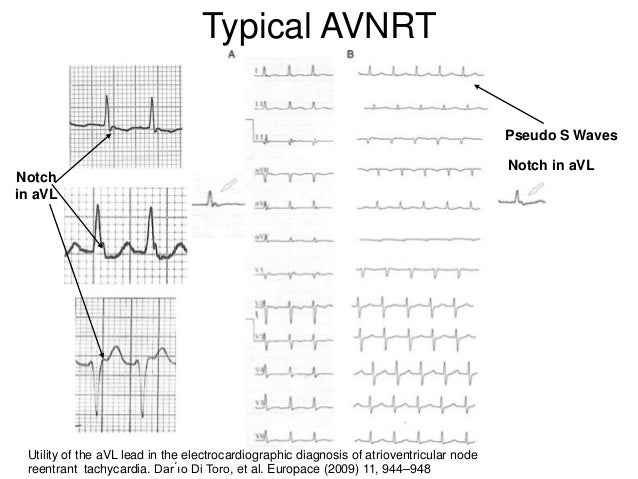 Avnrt Fast Tachycardia Nodal Reentrant Atrioventricular Slow Pathway ...