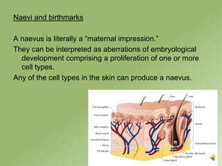 9. birthmarks and naevi | PPTX