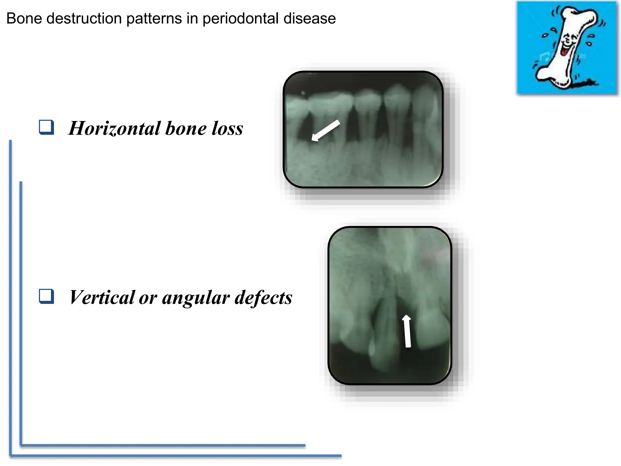 9-bonelosspatterns-read-160503155301.pptx