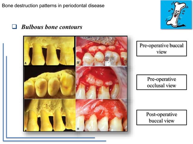 9-bonelosspatterns-read-160503155301.pptx | Bone and Joint Conditions ...