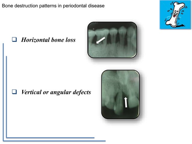 bone loss patterns