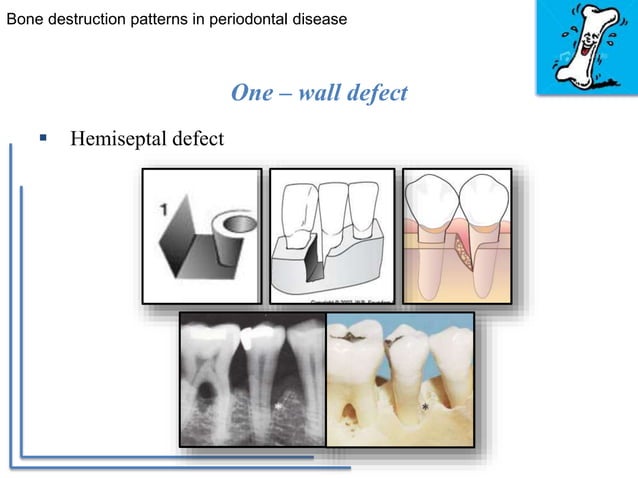 bone loss patterns | PPTX