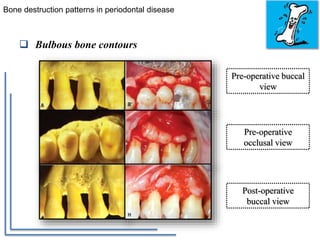 bone loss patterns | PPTX