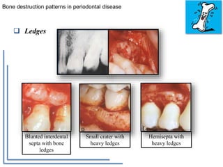bone loss patterns | PPTX