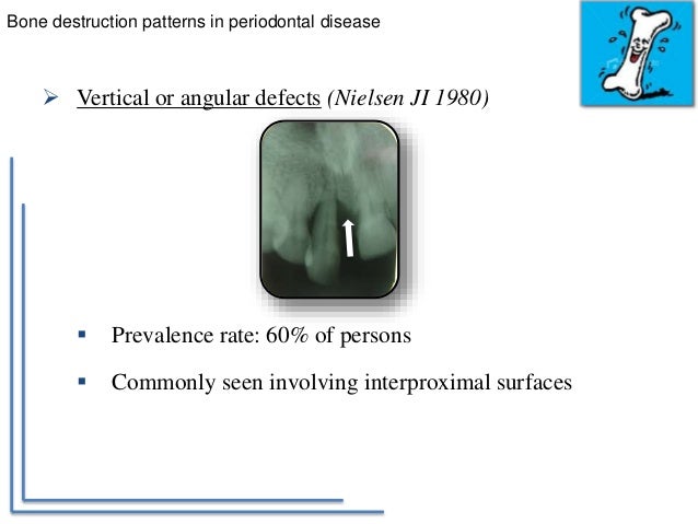 bone loss patterns