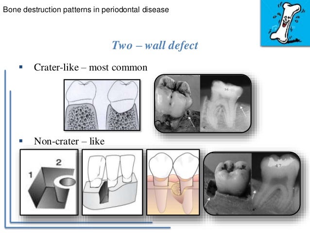 bone loss patterns