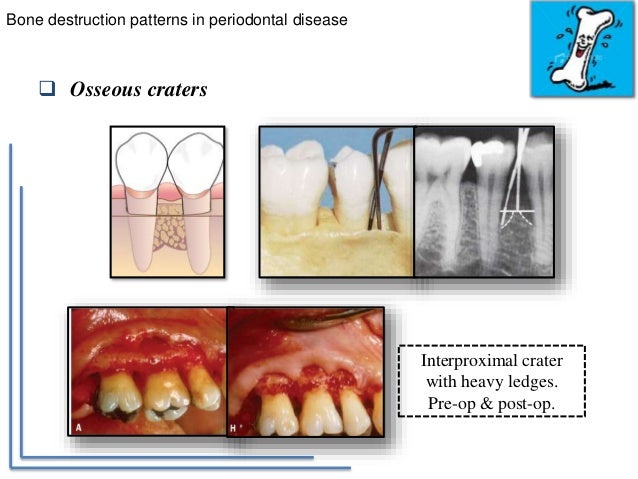 bone loss patterns