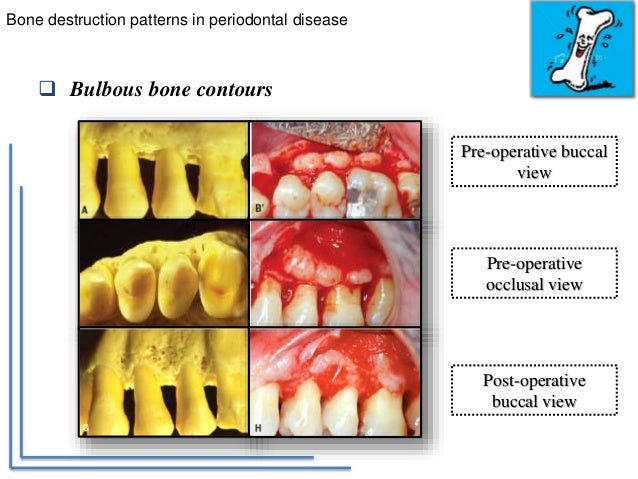 bone loss patterns