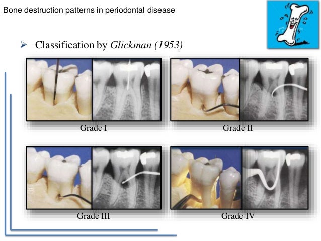 bone loss patterns