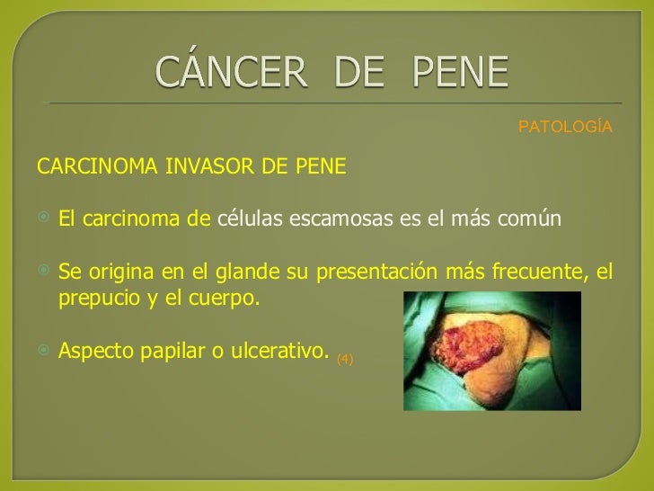 9 cancer de pene LUIS GABRIEL PEREZ SANTOS