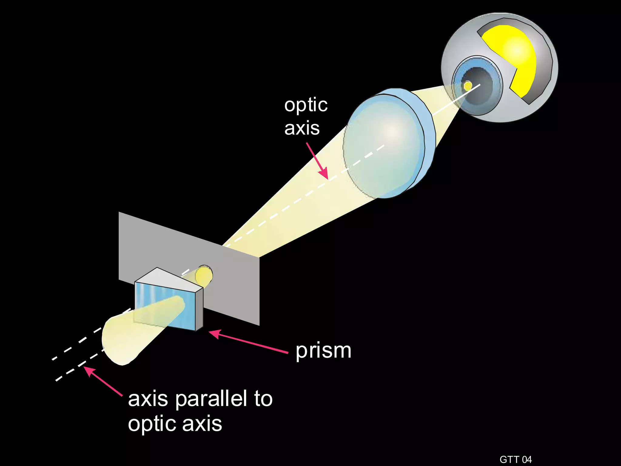 9-Indirect Ophthalmoscope.ppt