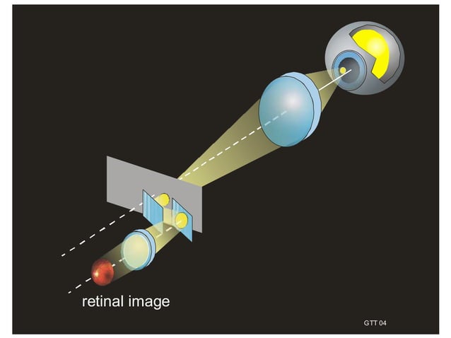 9-Indirect Ophthalmoscope.ppt
