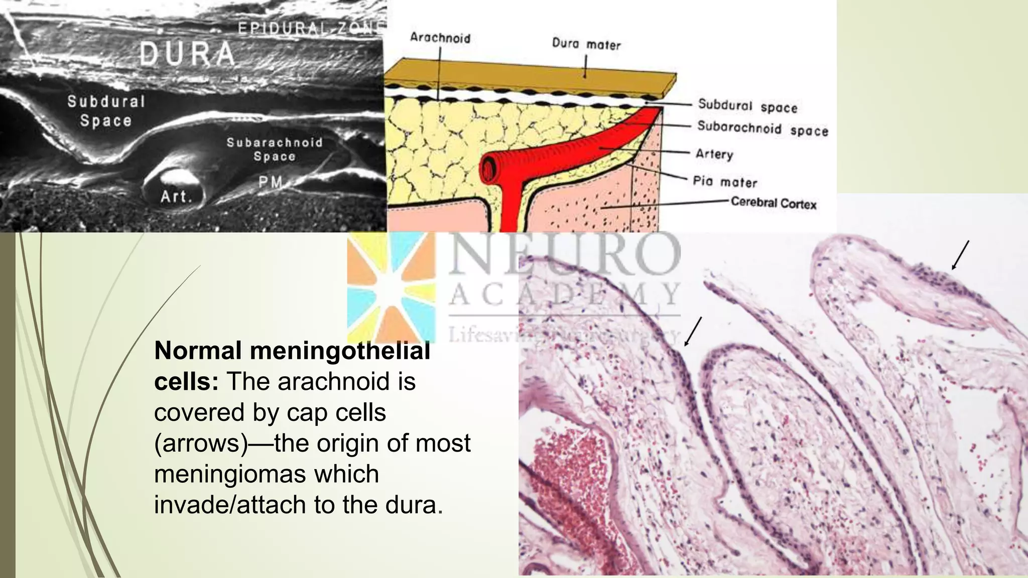 Multiple Meningiomas and Meningiomatosis. Molecular Pathogenesis | PPTX