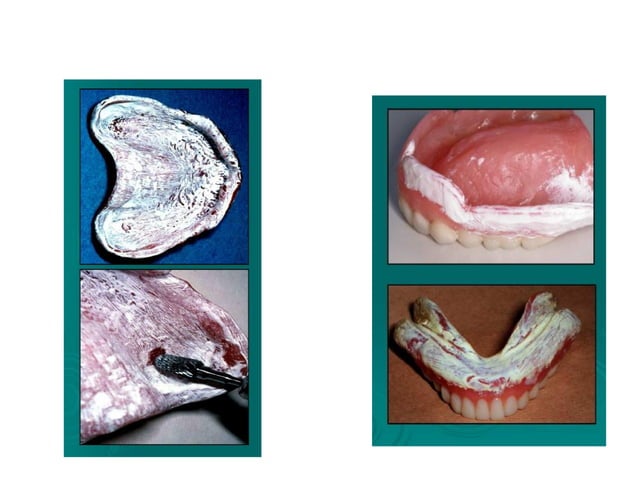 9 new denture insertion | PDF