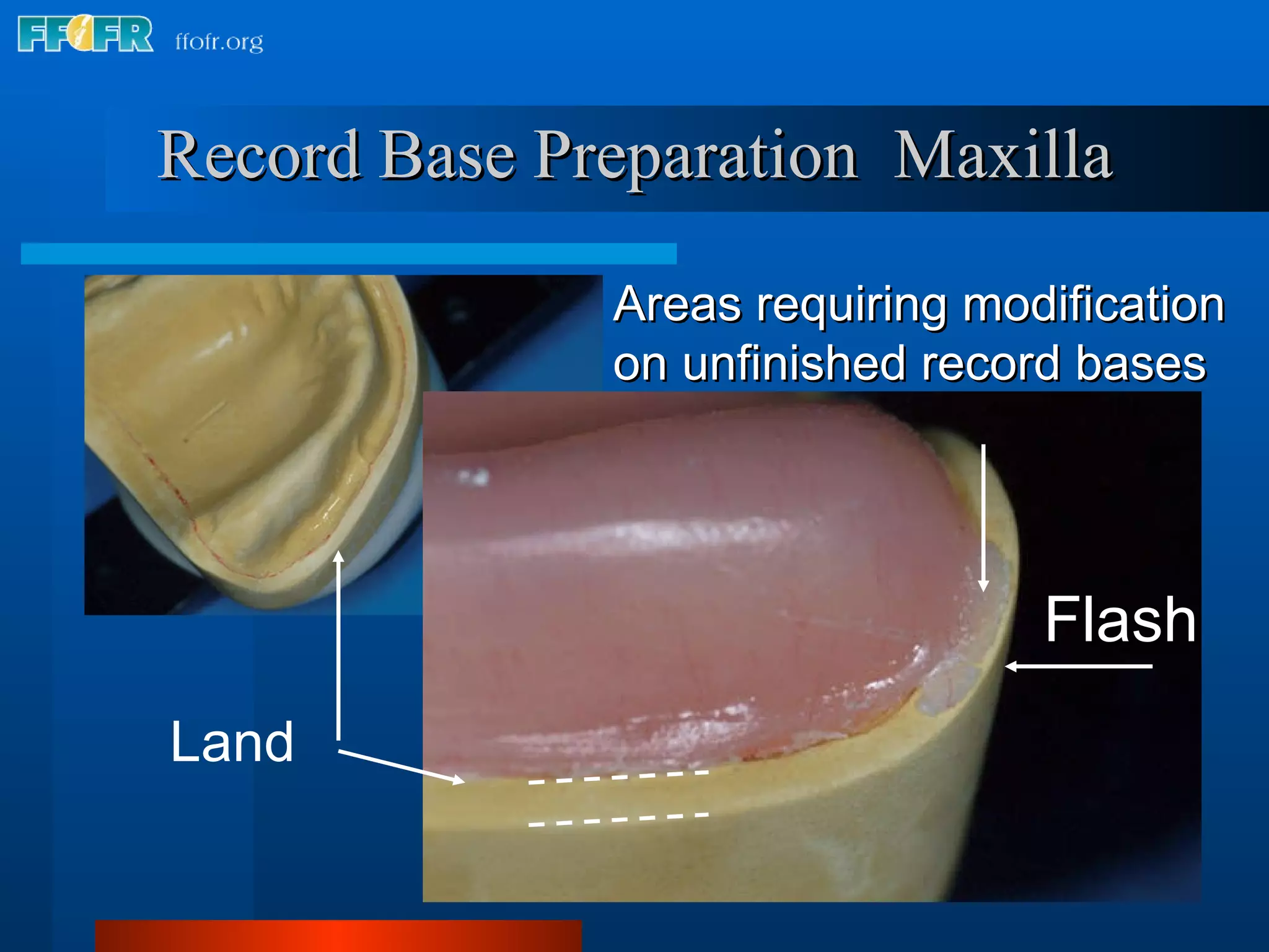 9.record base and wax rim fabrication | PPT