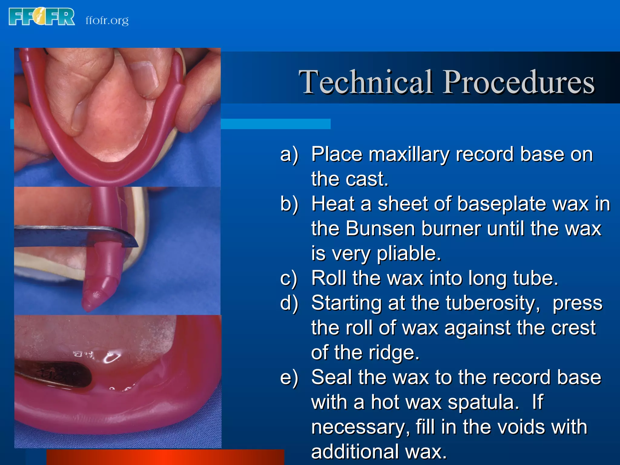 9.record base and wax rim fabrication | PPT