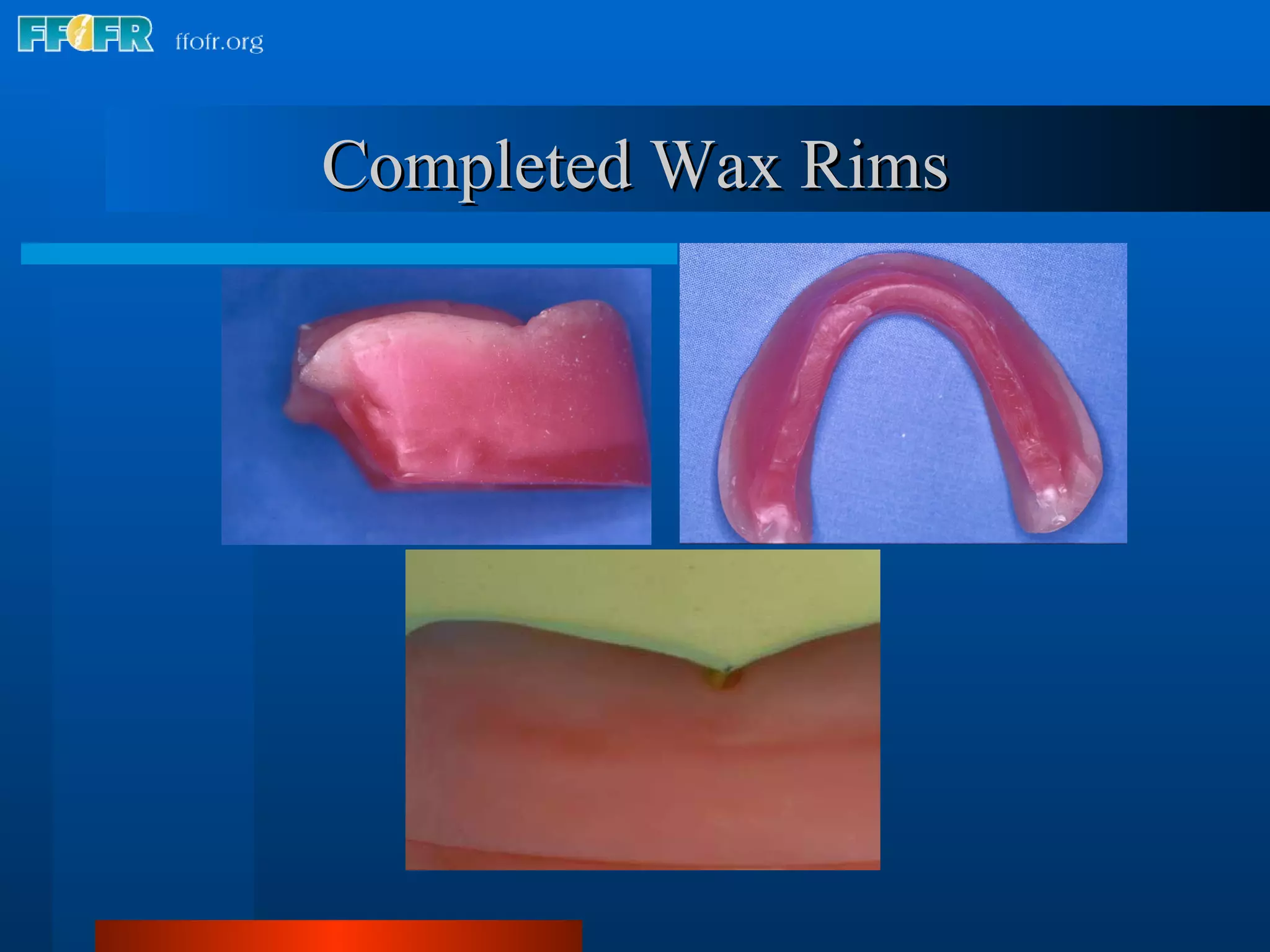 9.record base and wax rim fabrication | PPT