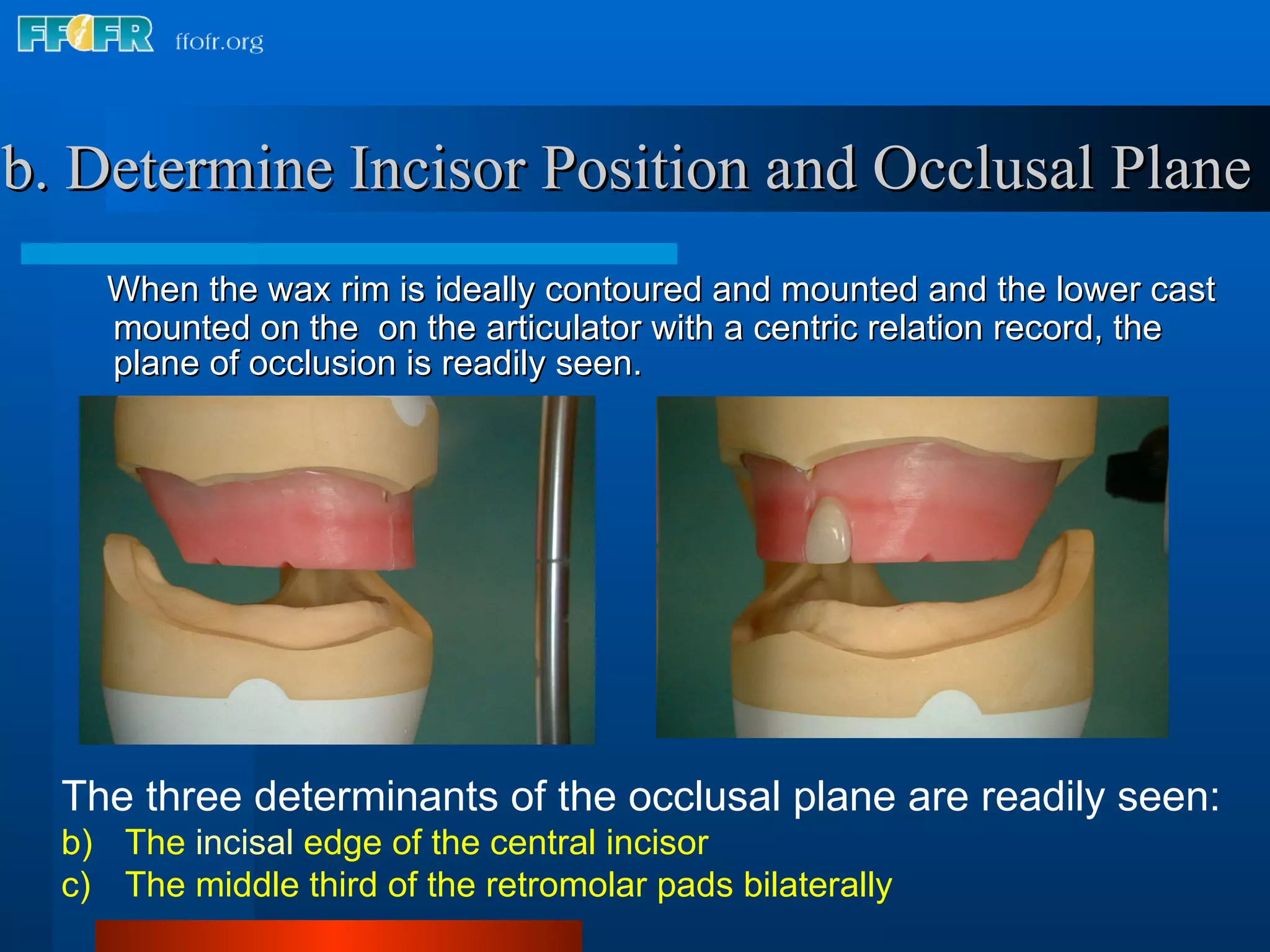 9.record base and wax rim fabrication | PPT