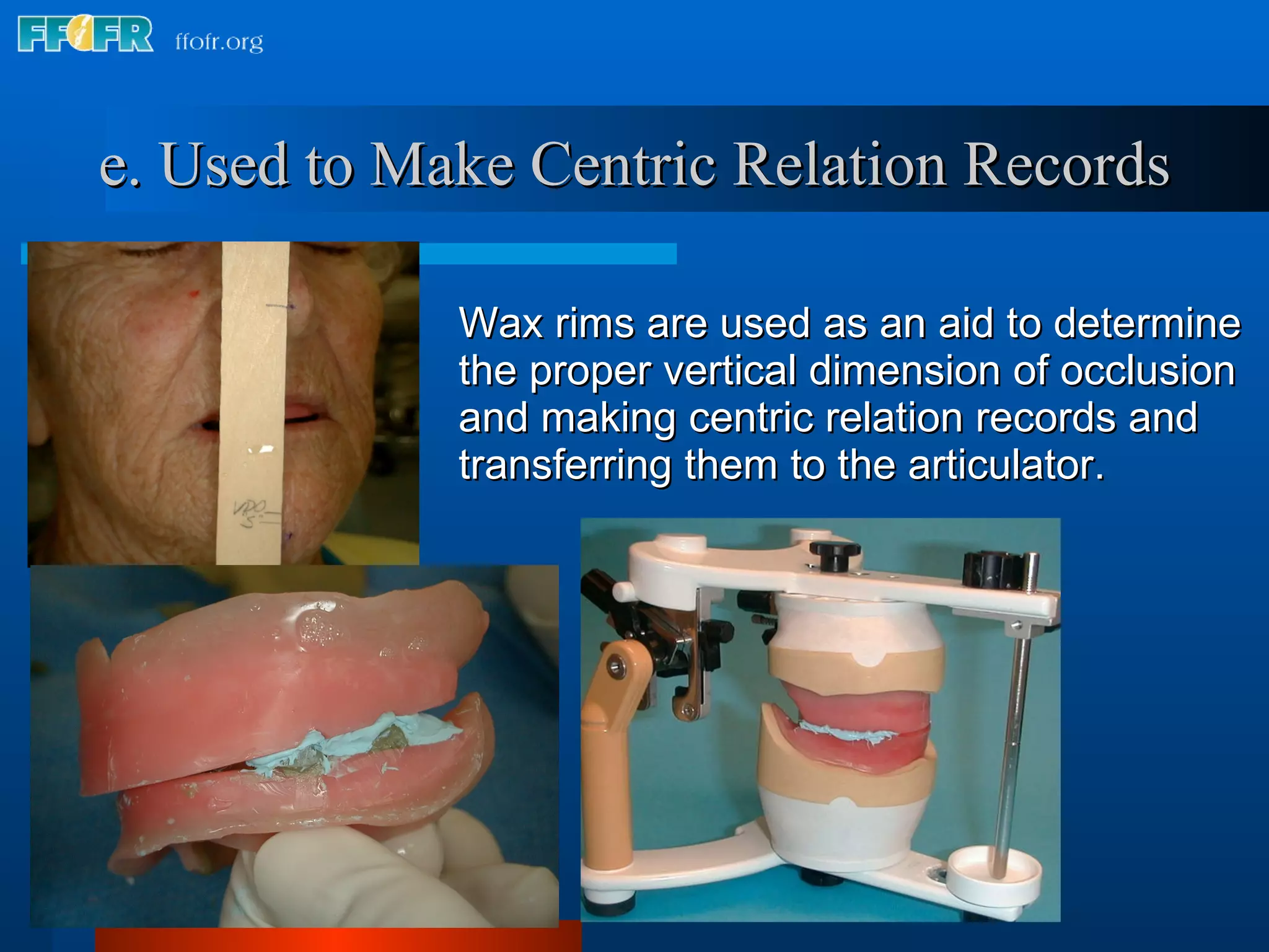 9.record base and wax rim fabrication | PPT