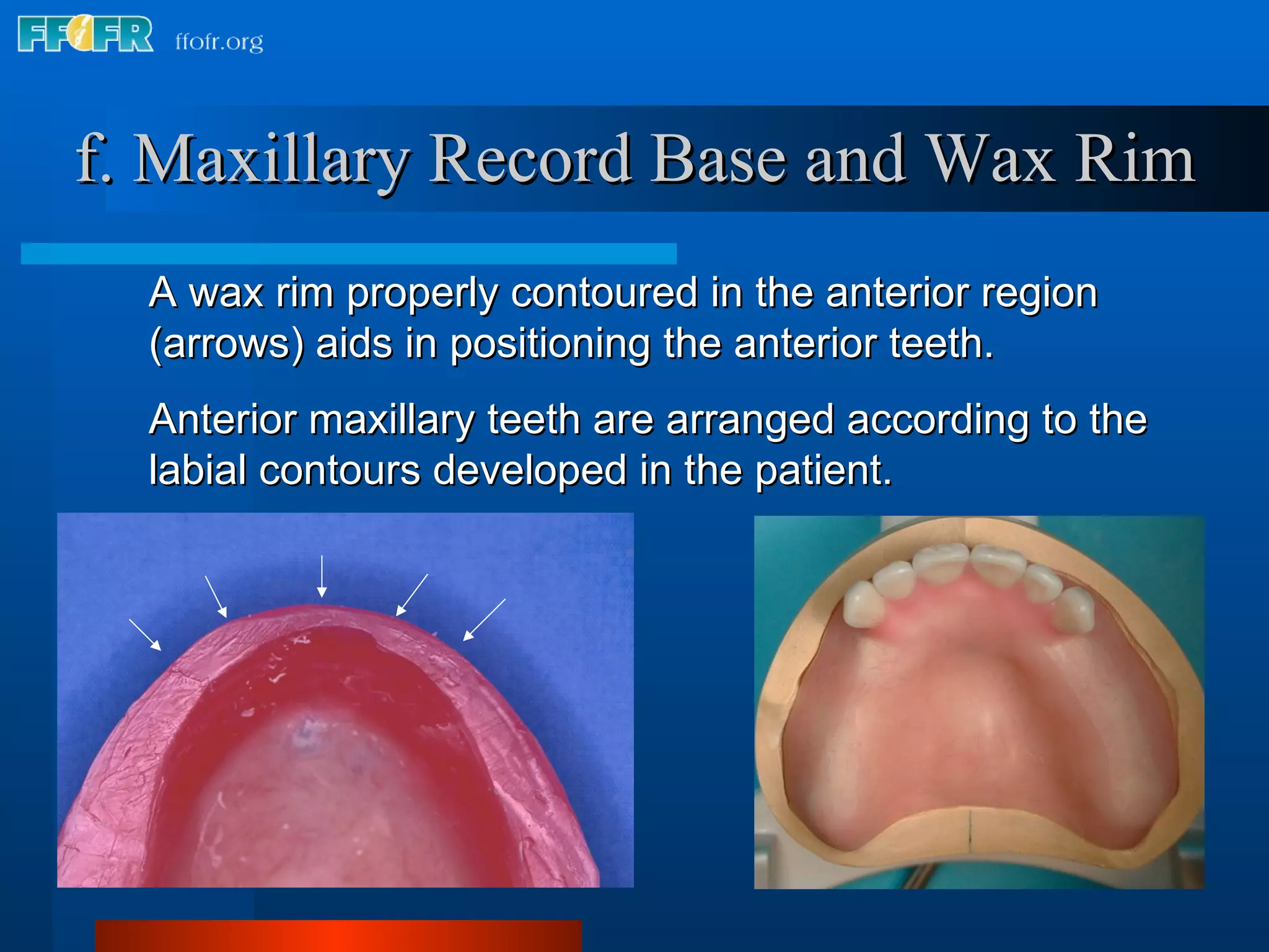9.record base and wax rim fabrication | PPT