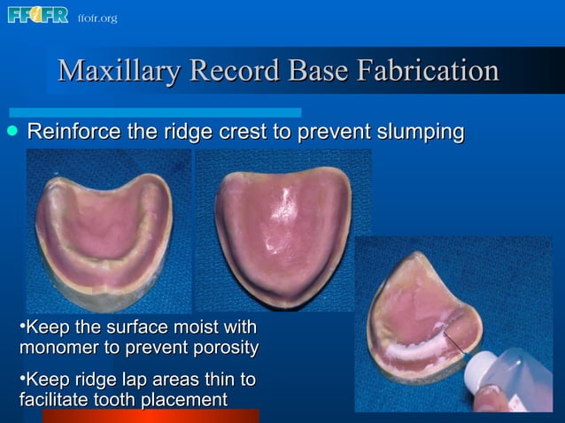 9.record base and wax rim fabrication | PPT