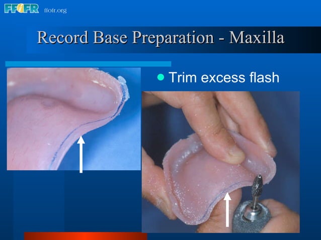 9.record base and wax rim fabrication | PPT