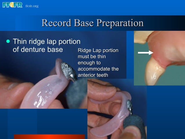 9.record base and wax rim fabrication | PPT