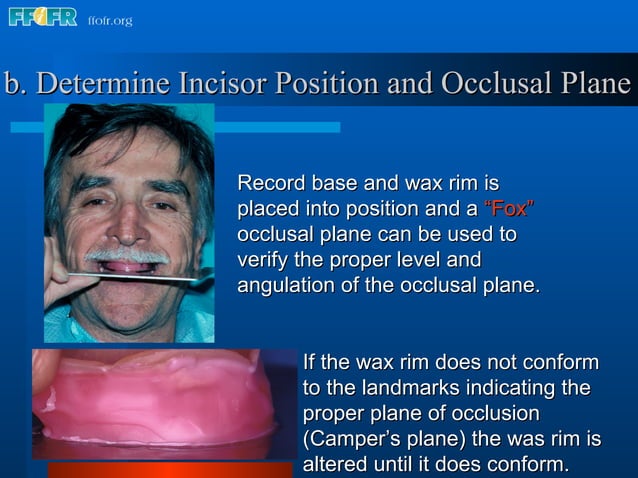 9.record base and wax rim fabrication | PPT